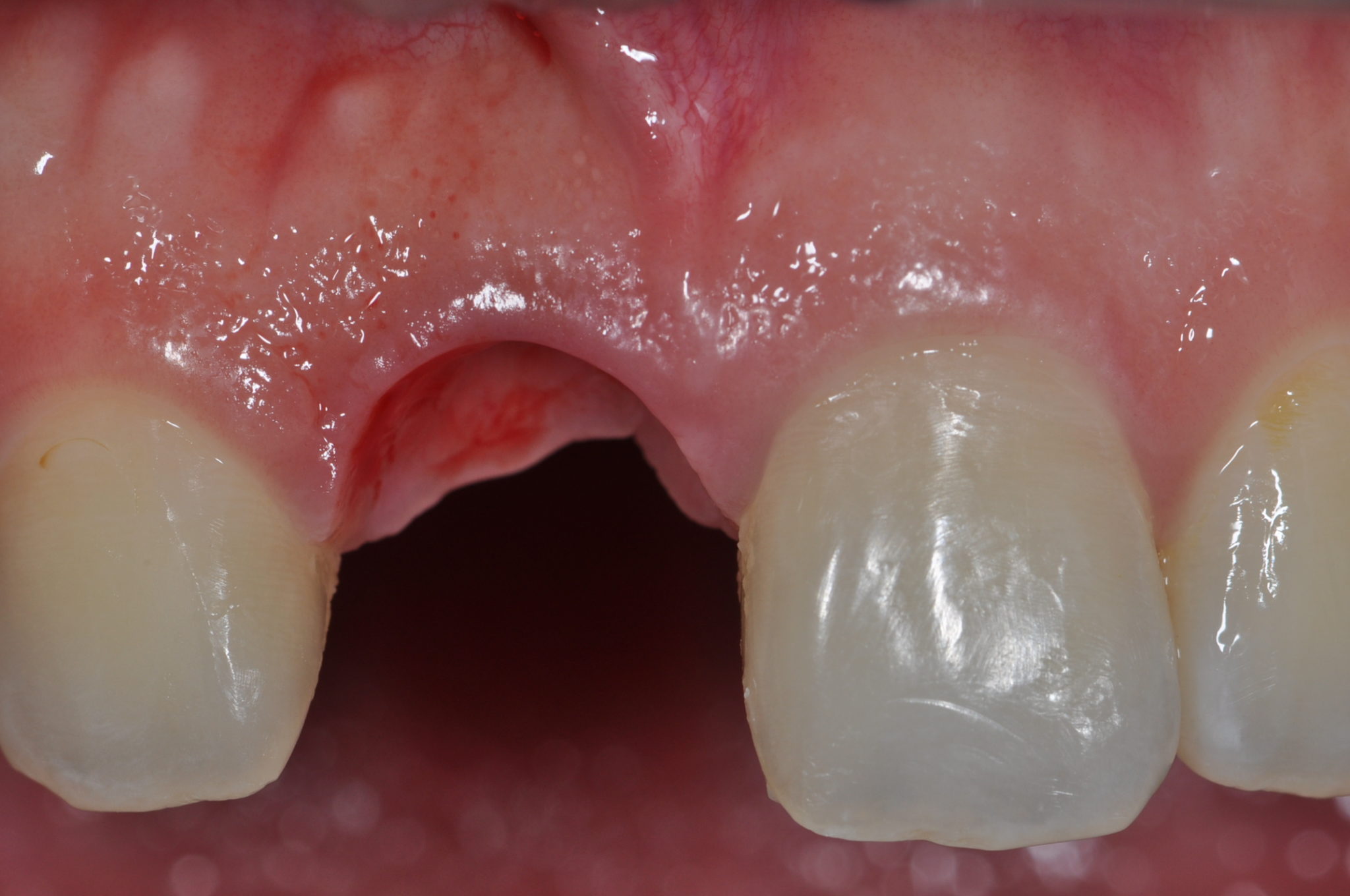 Essentials of Anterior Implant – INSTITUTE OF ADVANCED DENTAL EDUCATION ...